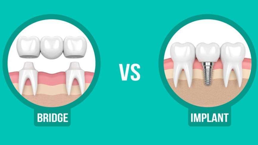 Bridges vs. Implants: Which is Better for Replacing a Missing Tooth ...